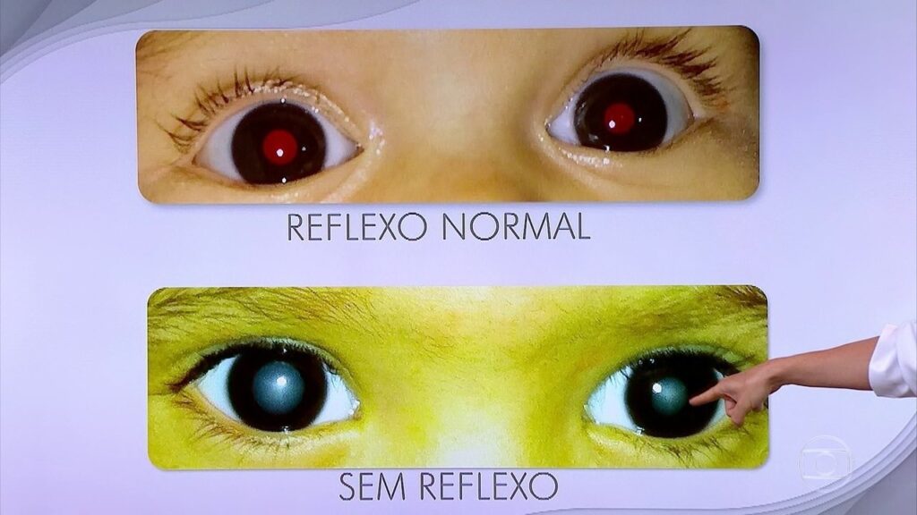 Teste do Olhinho – AMO Oftalmologia