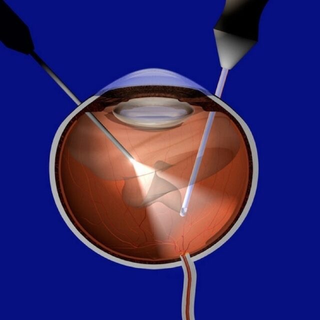 Vitrectomia – AMO Oftalmologia